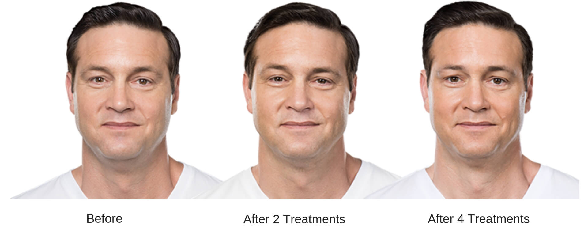 Kybella Treatment | FDA Approved | Goodbye Double Chin